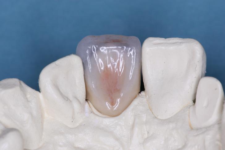 Intarsi dentali: cosa sono, come funzionano e benefici