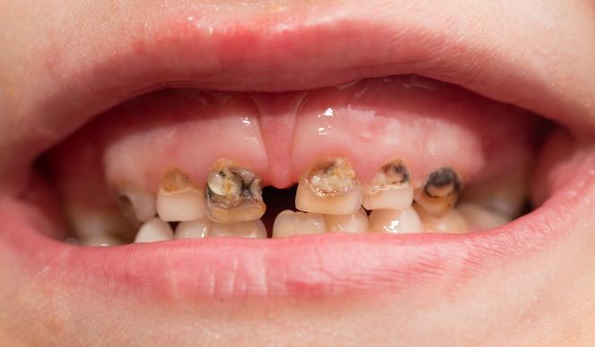 Radice dente marcia - Cause, rimedi e come prevenire le carie