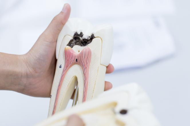 Radice dente non estratta - Quali sono i rischi e i rimedi