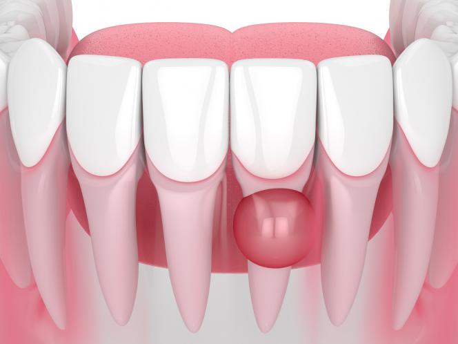 Bucare ascesso gengivale - Si può fare con ago? Le info