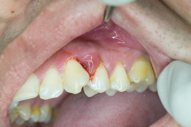 Rigonfiamento gengiva - Quali sono le possibili cause