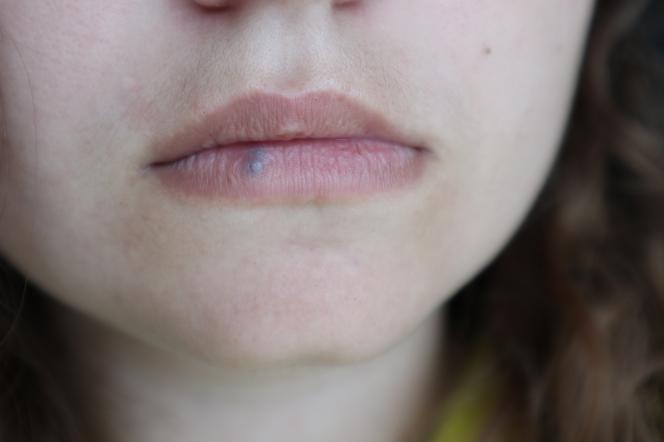 Tumore alle labbra della bocca sintomi - Ecco quali sono